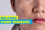Top 10 Home Remedies To Cure Melasma Naturally - Tips and Beauty